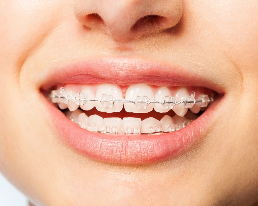 Clear vs. Metal Braces Top Orthodontist Beverly Hills